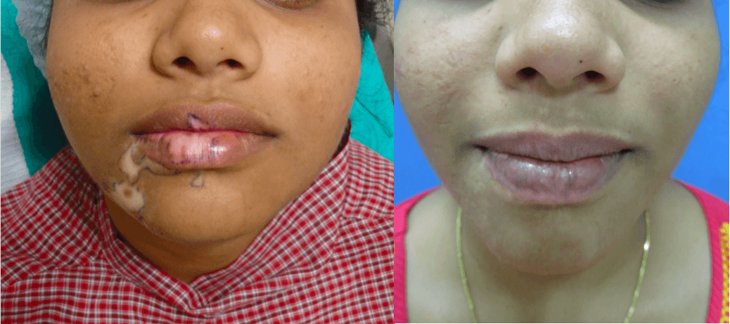 Leucoderma Treatments | Venkat Center For Aesthetic Health